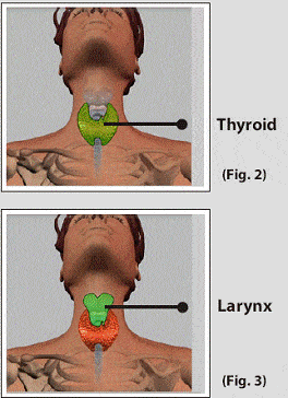 Thyroid Surgery Sydney | Thyroid Cancer Sydney
